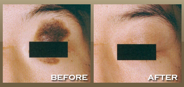 Skinpeccable Mole Removal Los Angeles