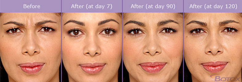 Botox in West Hollywood: Unlock Your Fountain of Youth